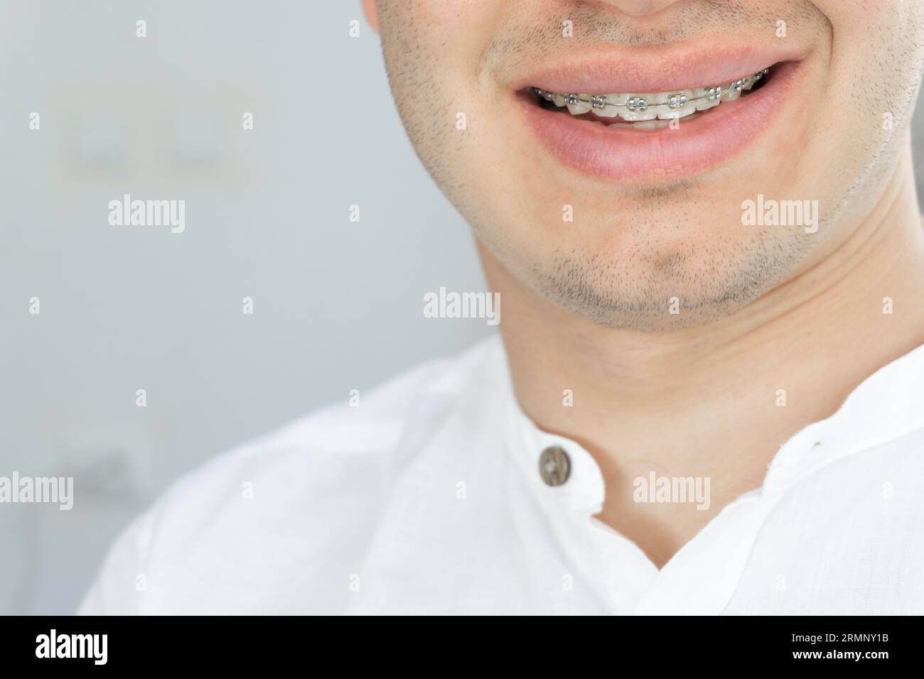Close up of the smile of a handsome young man with braces smiling with ...