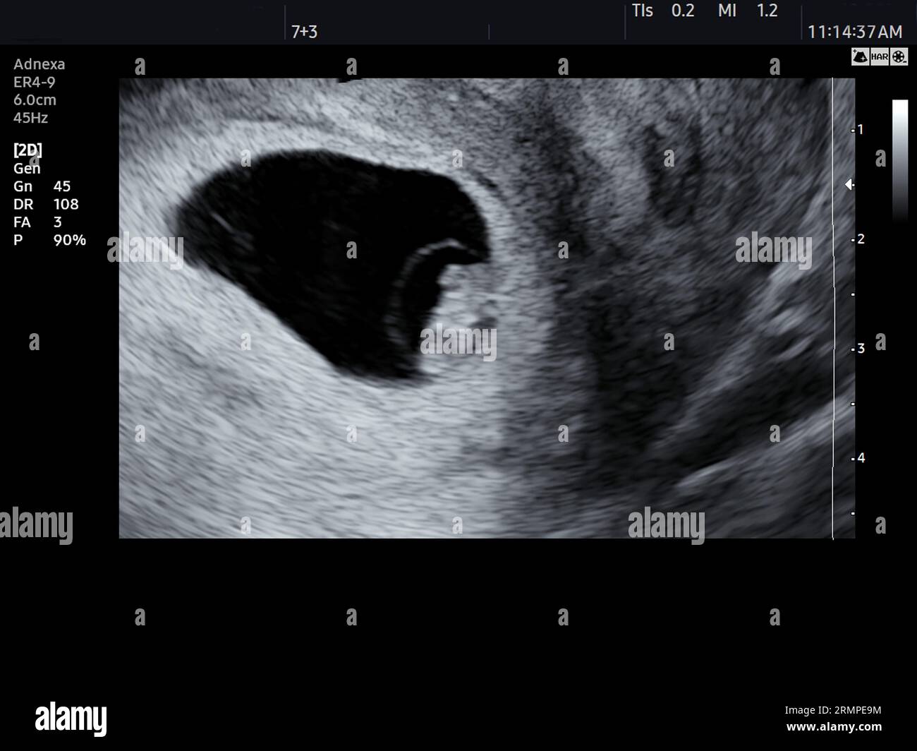Embryo at 7 weeks, ultrasound scan Stock Photo - Alamy