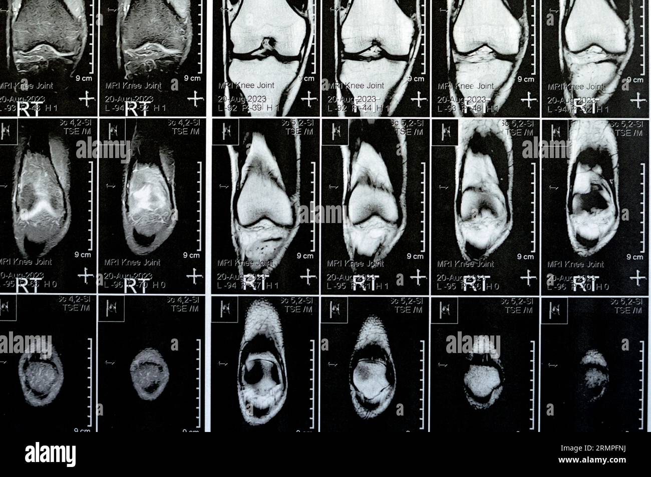 MRI of the right knee showing mild joint effusion, with normal other ...