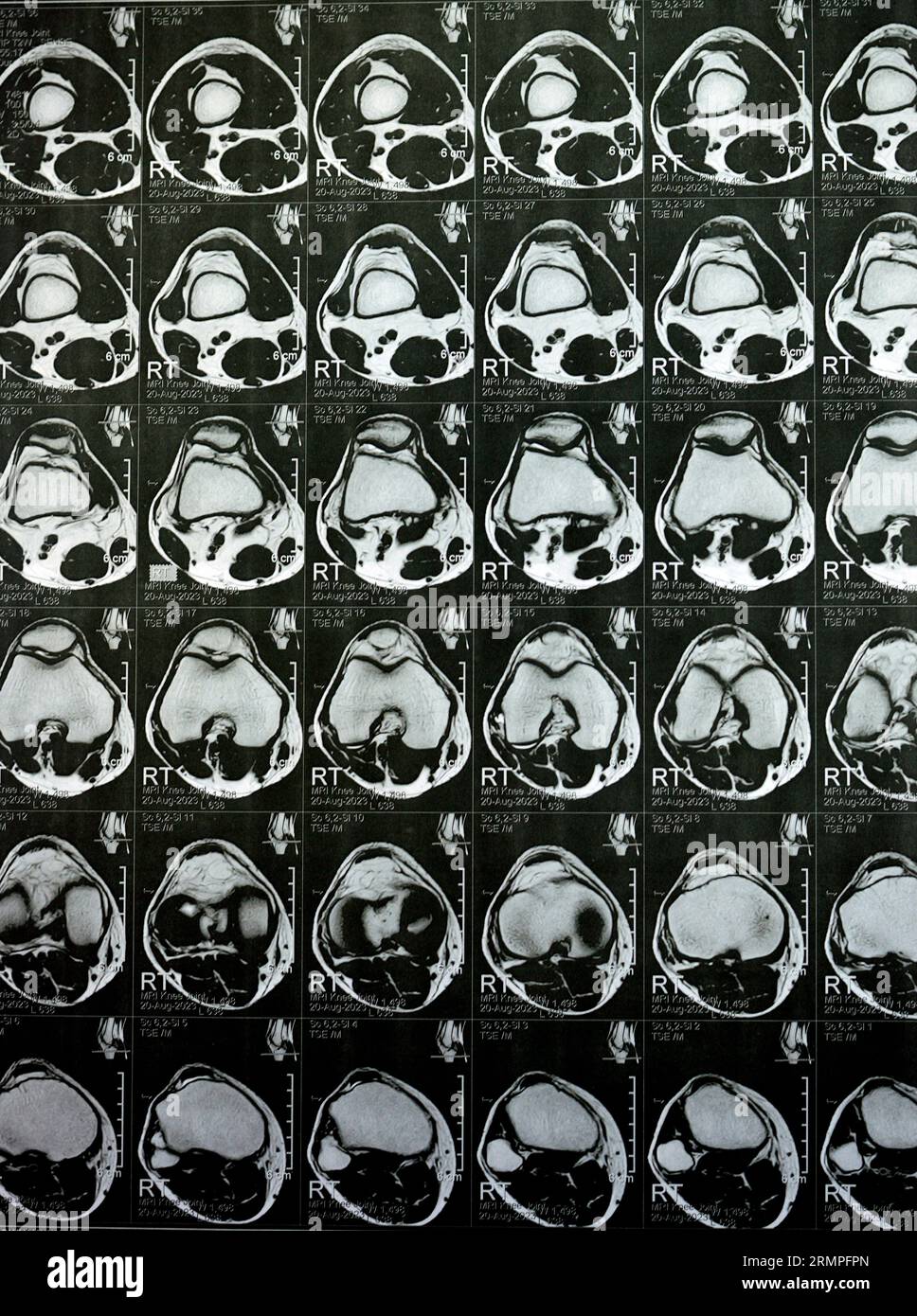 MRI of the right knee showing mild joint effusion, with normal other ...