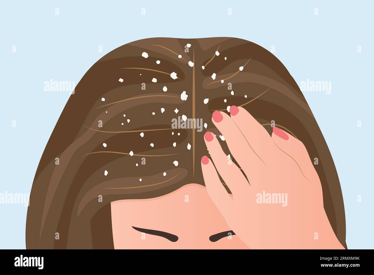 woman with dandruff on the hair- vector illustration Stock Vector Image ...