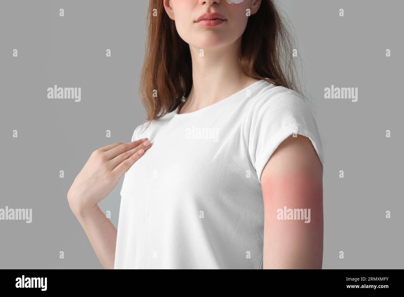 Dermatitis solar hi-res stock photography and images - Alamy