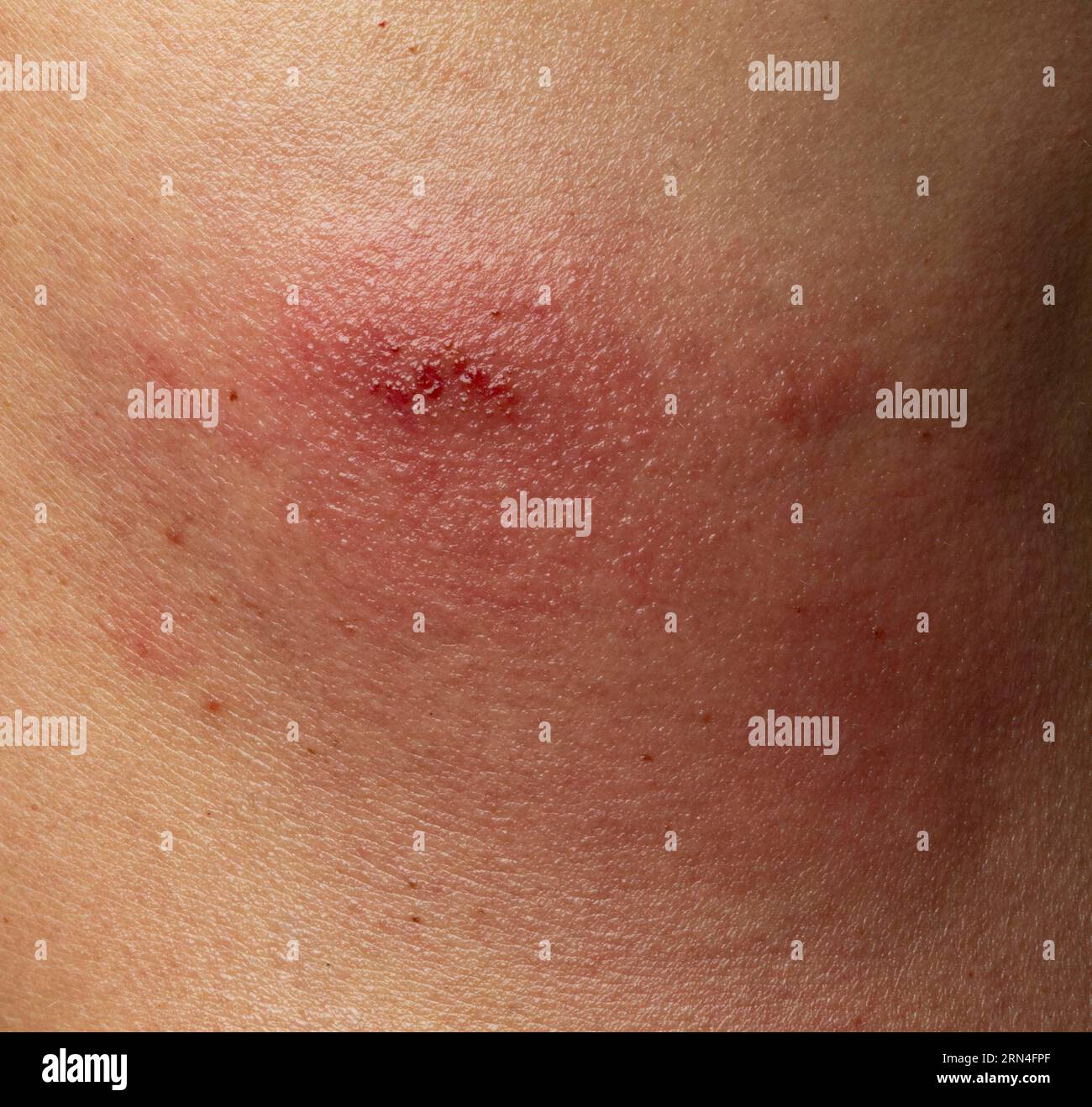 Skin reaction hi-res stock photography and images - Alamy