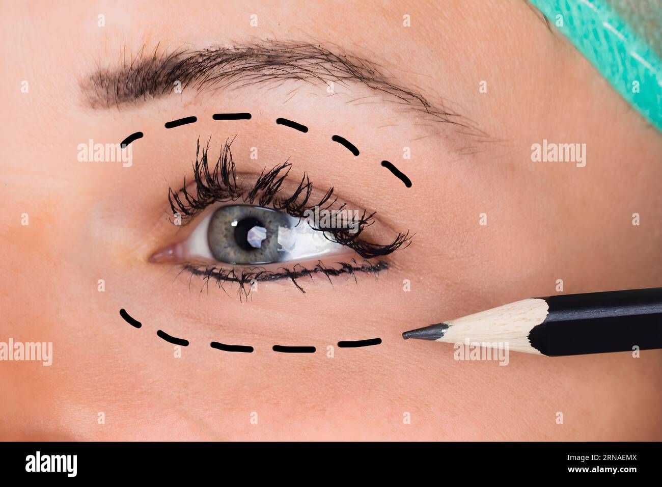 Close-up Of A Surgeon Drawing Perforation Lines On Young Woman's Face ...