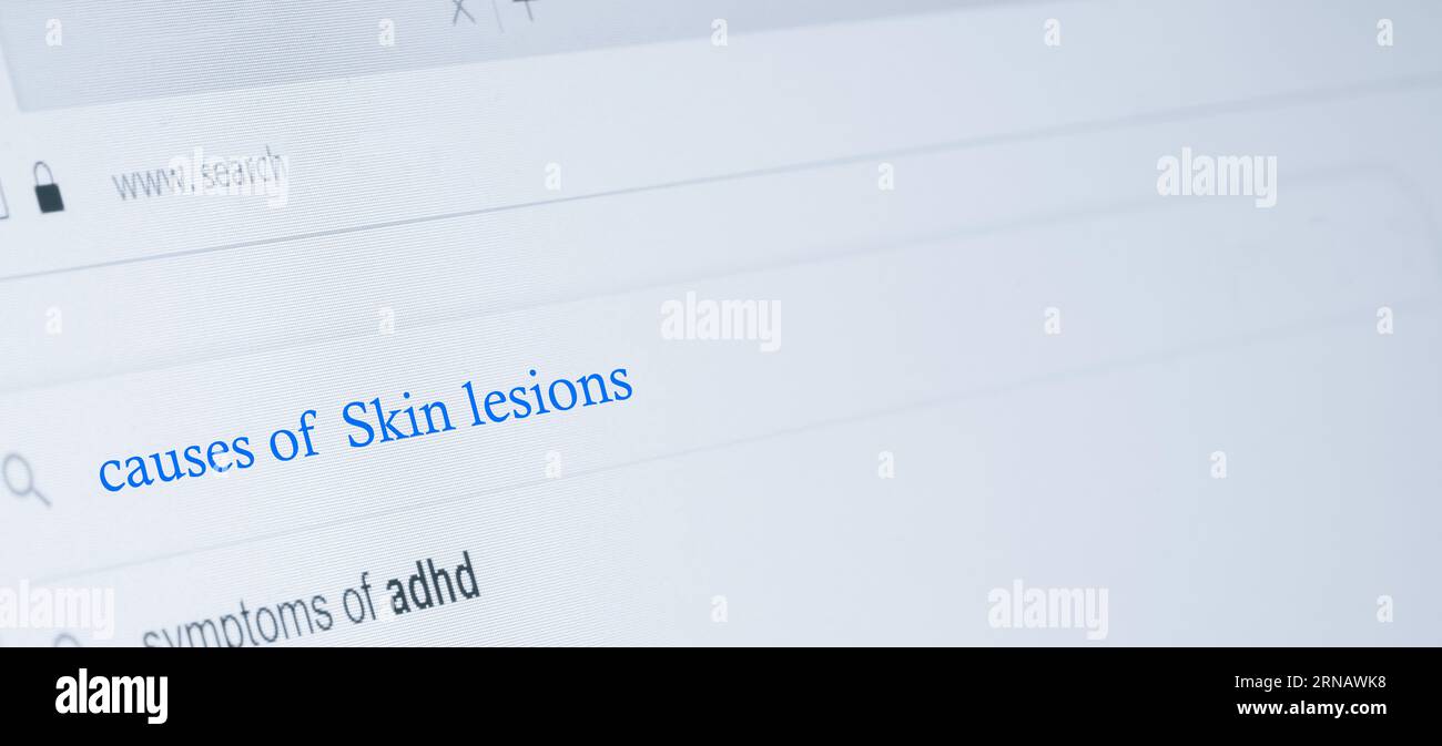 Skin lesions search for the cause of malaise on the Internet on a ...