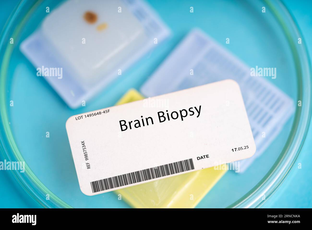 Brain biopsy. A small piece of brain tissue to evaluate for conditions ...