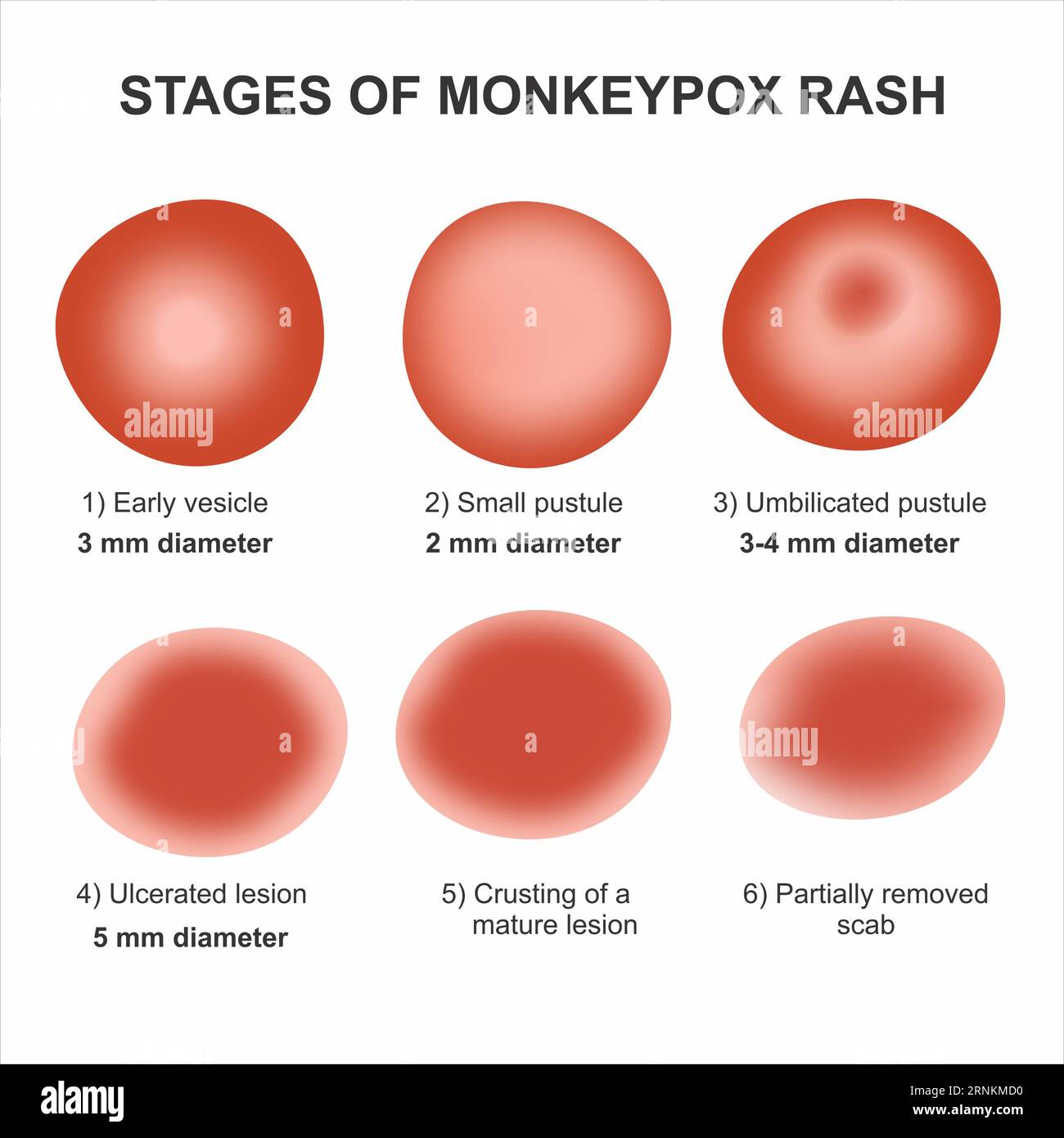 Monkeypox rash of stages illustration Stock Photo - Alamy