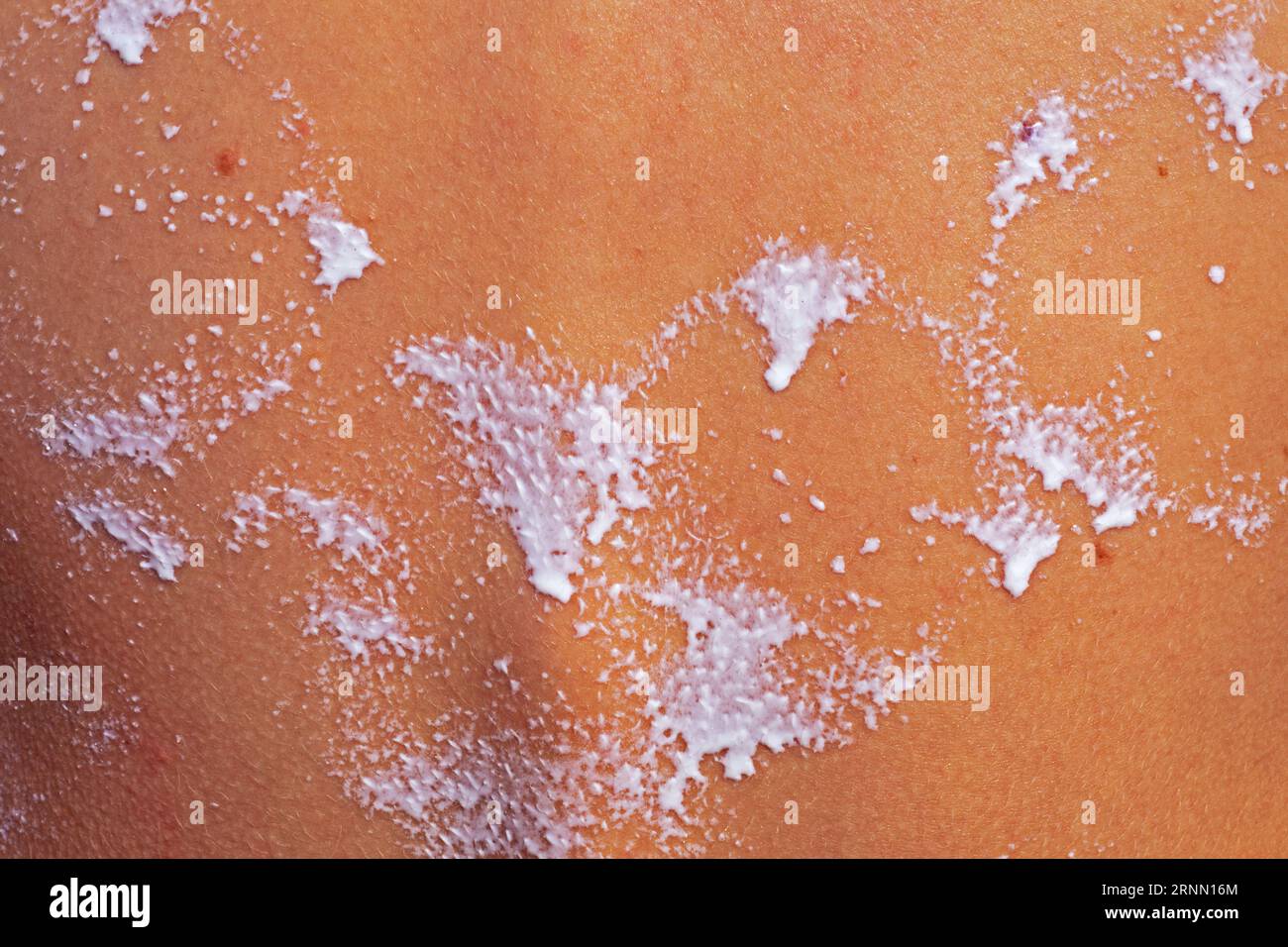 Apply sunscreen to fair skin. body care Stock Photo - Alamy
