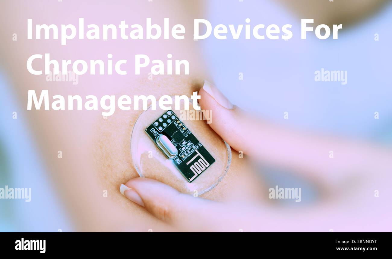 Implantable devices for chronic pain management: Neurostimulators or ... Implantable devices for chronic pain management: Neurostimulators or ...