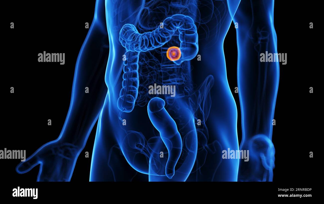 Colectomy hi-res stock photography and images - Alamy