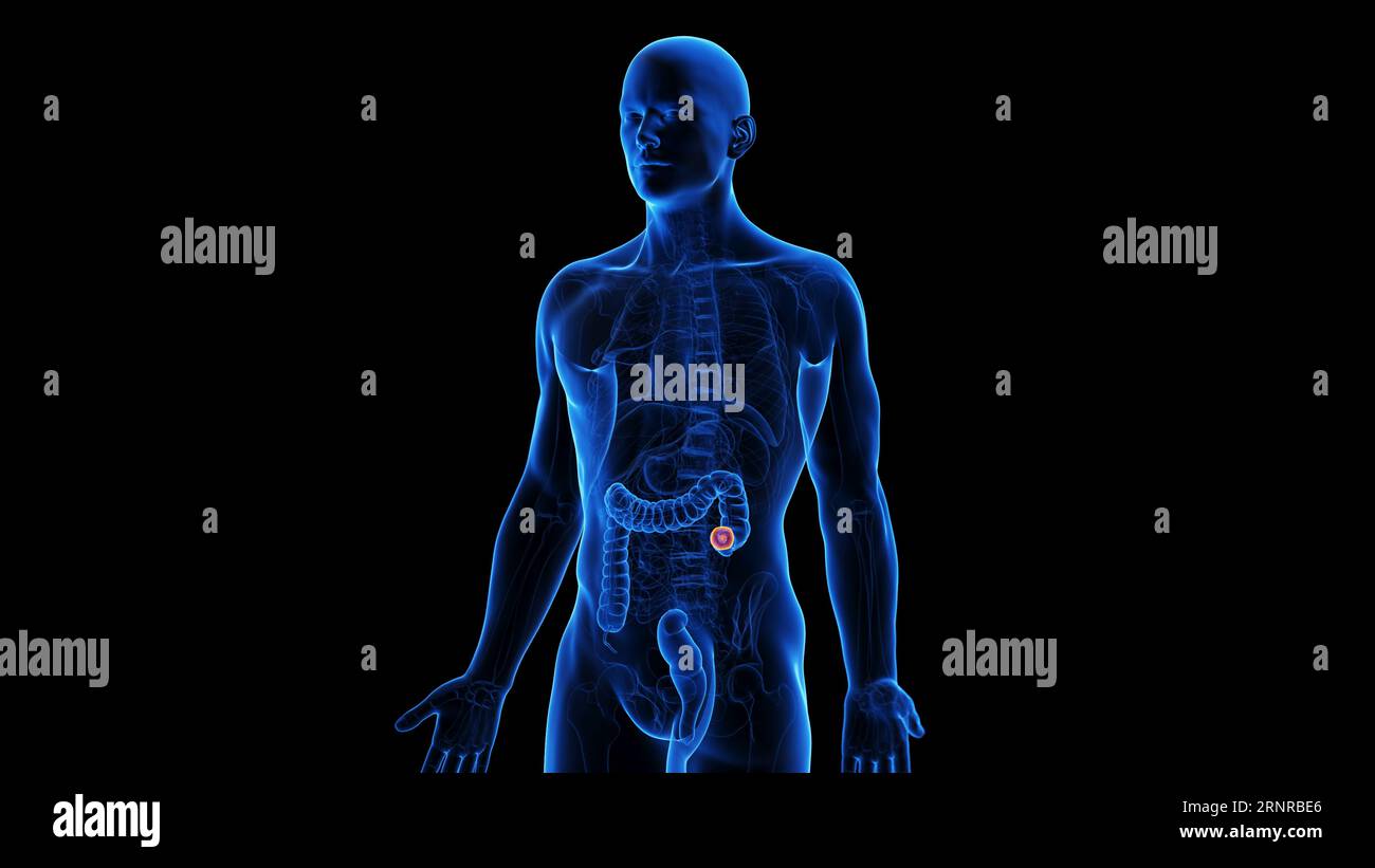 Colectomy hi-res stock photography and images - Alamy