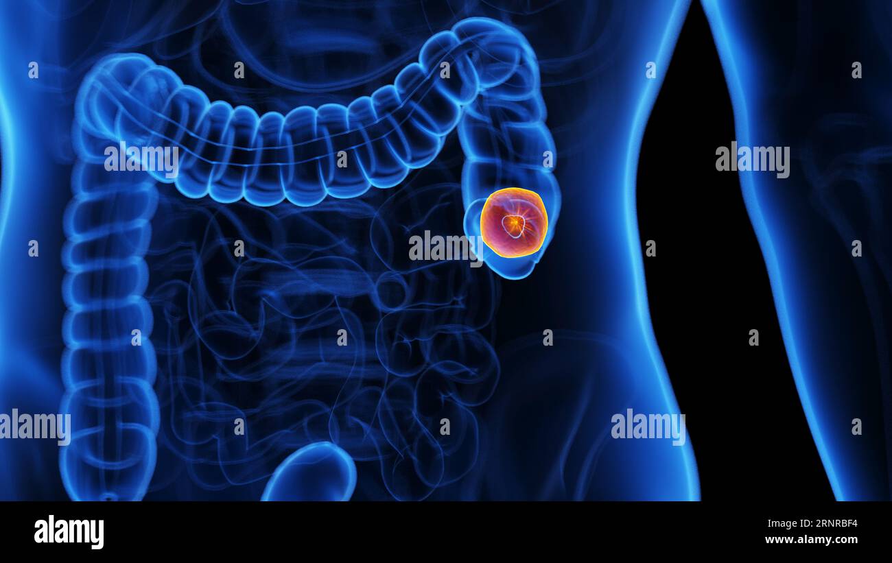 Colectomy hi-res stock photography and images - Alamy