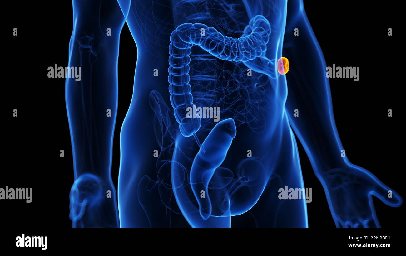 Colectomy hi-res stock photography and images - Alamy