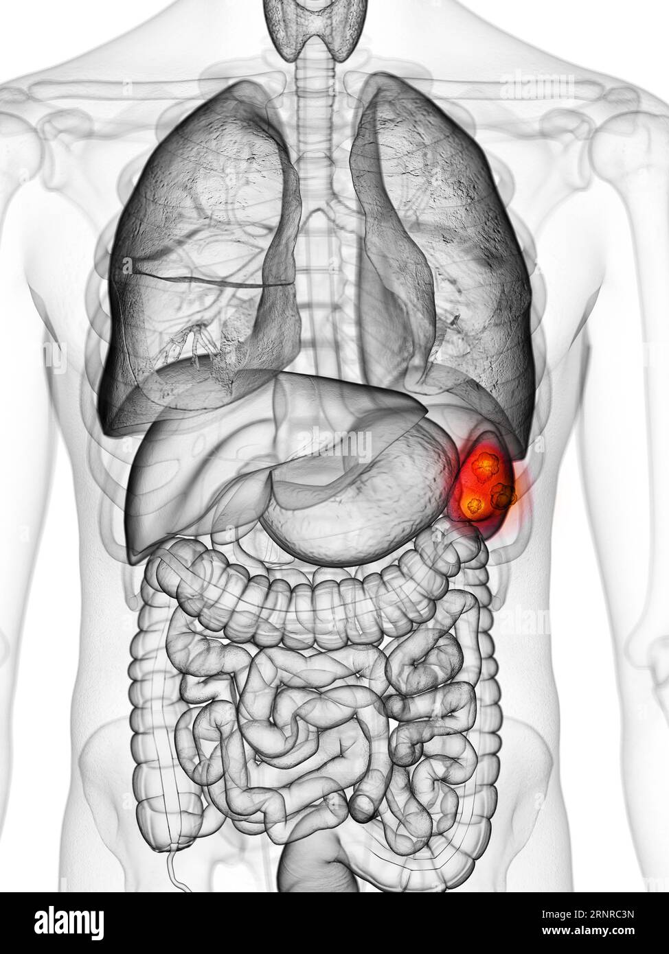 Spleen cancer, illustration Stock Photo - Alamy