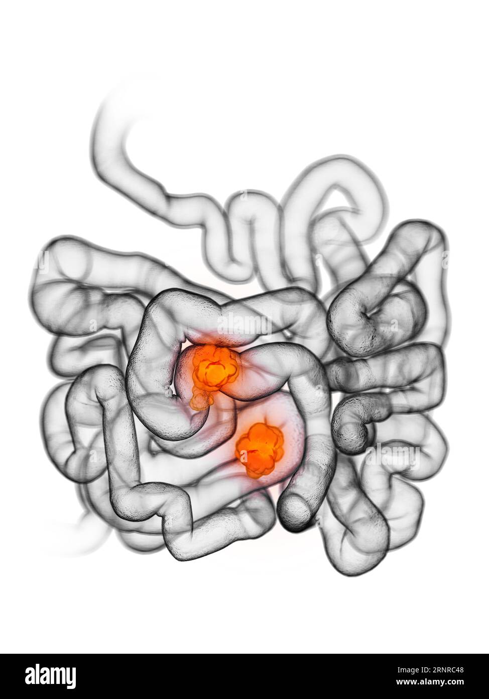 Gut cancer Cut Out Stock Images & Pictures - Alamy