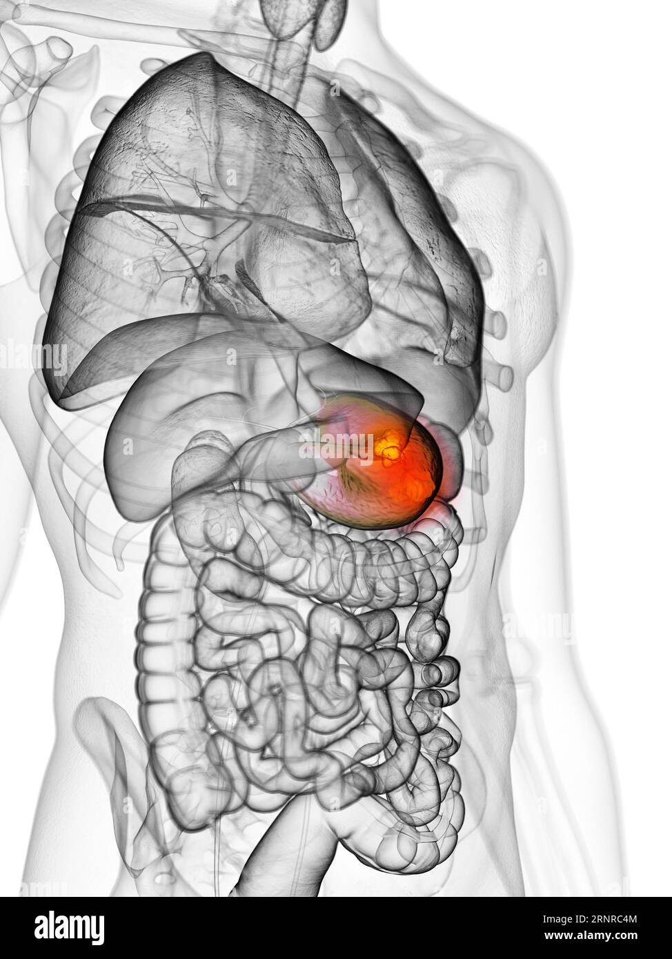 Stomach cancer, illustration Stock Photo - Alamy