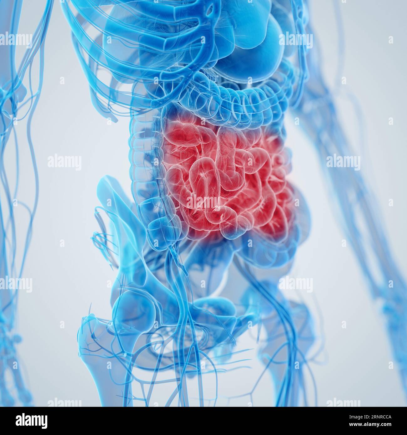 Inflamed intestine, illustration Stock Photo - Alamy