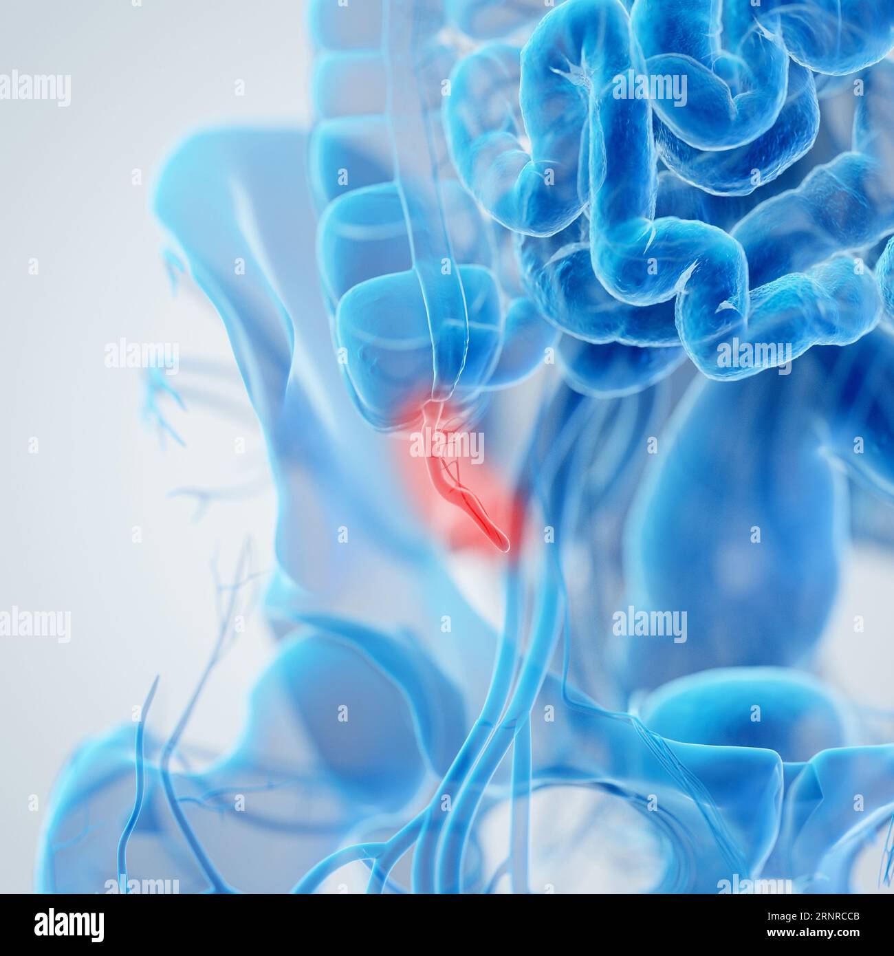 Inflamed appendix, illustration Stock Photo - Alamy