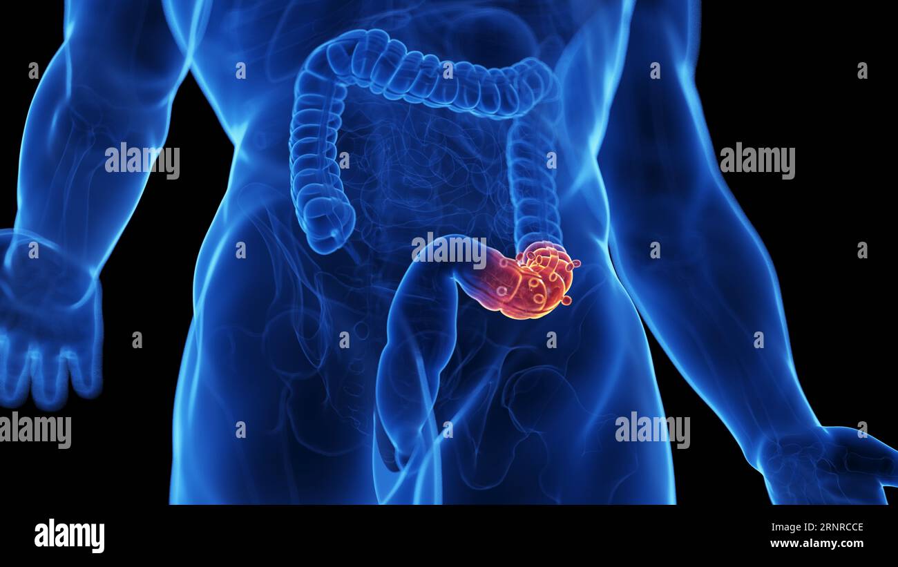 Diverticulitis intestinal hi-res stock photography and images - Alamy