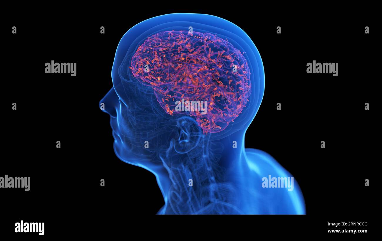 Infected human brain, illustration Stock Photo - Alamy