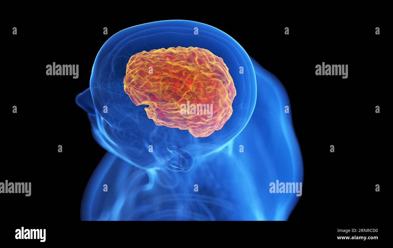 Degenerated human brain, illustration Stock Photo - Alamy