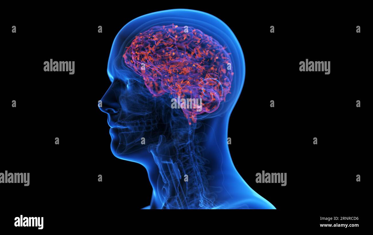 Infected human brain, illustration Stock Photo - Alamy