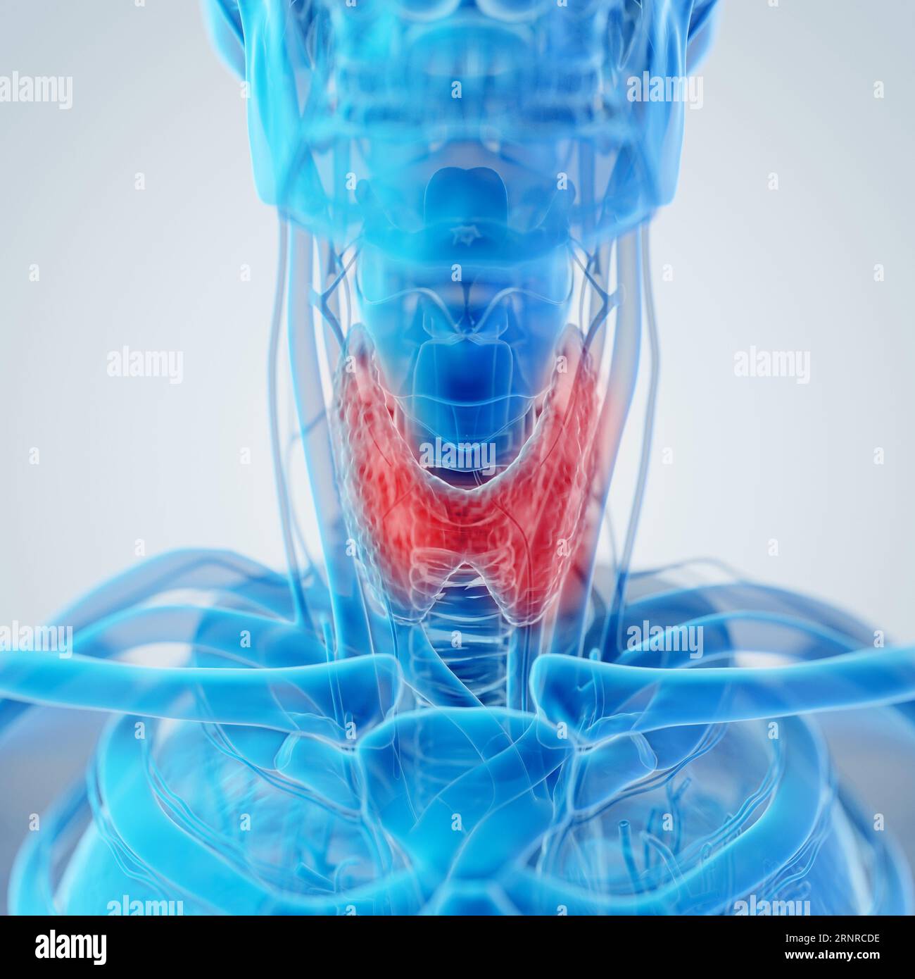 Inflamed thyroid gland, illustration Stock Photo - Alamy