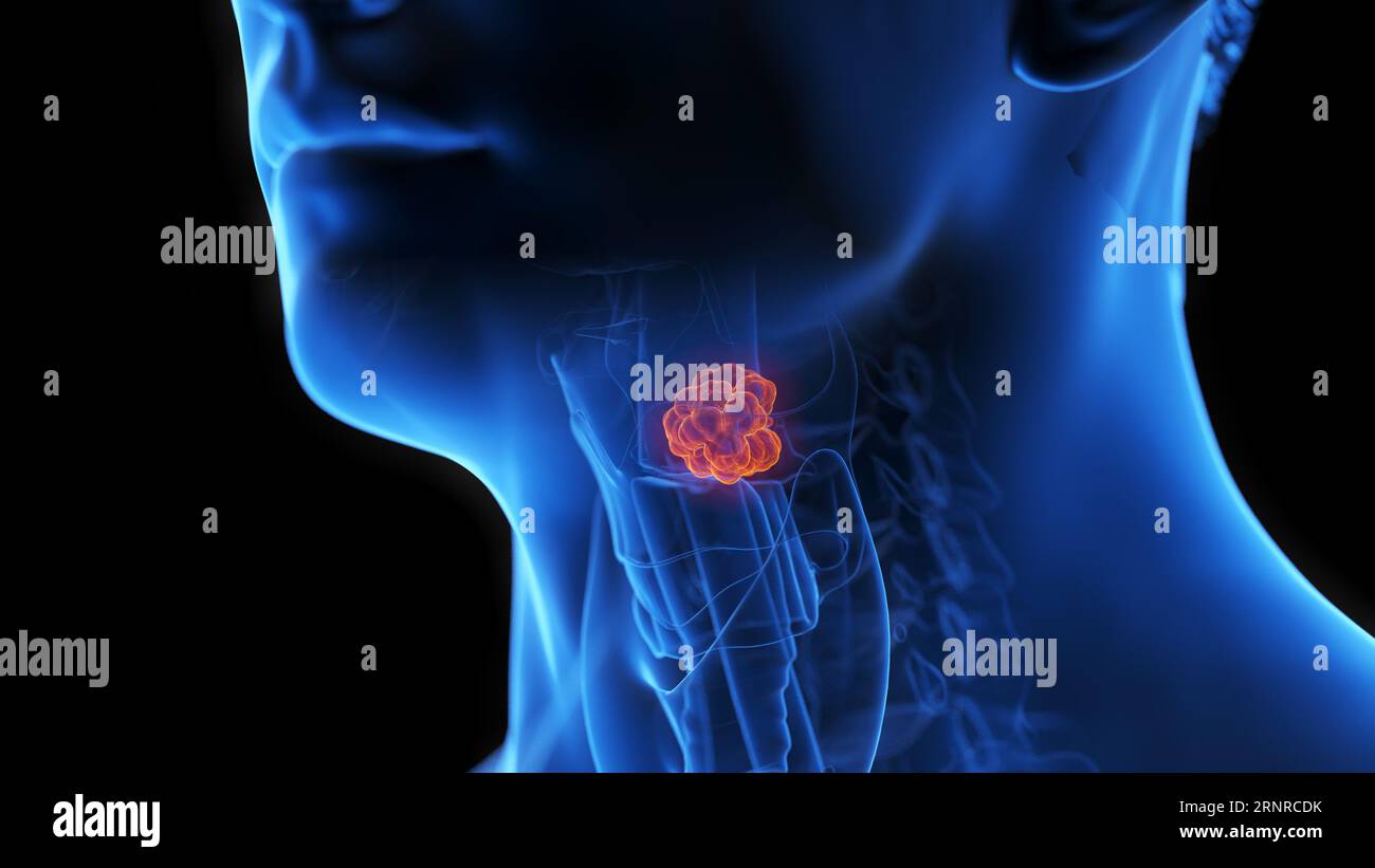 Larynx tumour, illustration Stock Photo - Alamy