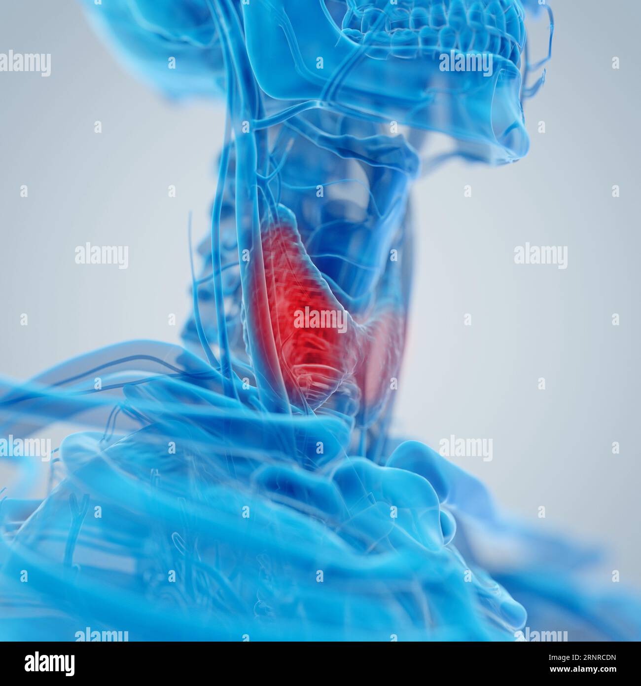 Inflamed thyroid gland, illustration Stock Photo - Alamy