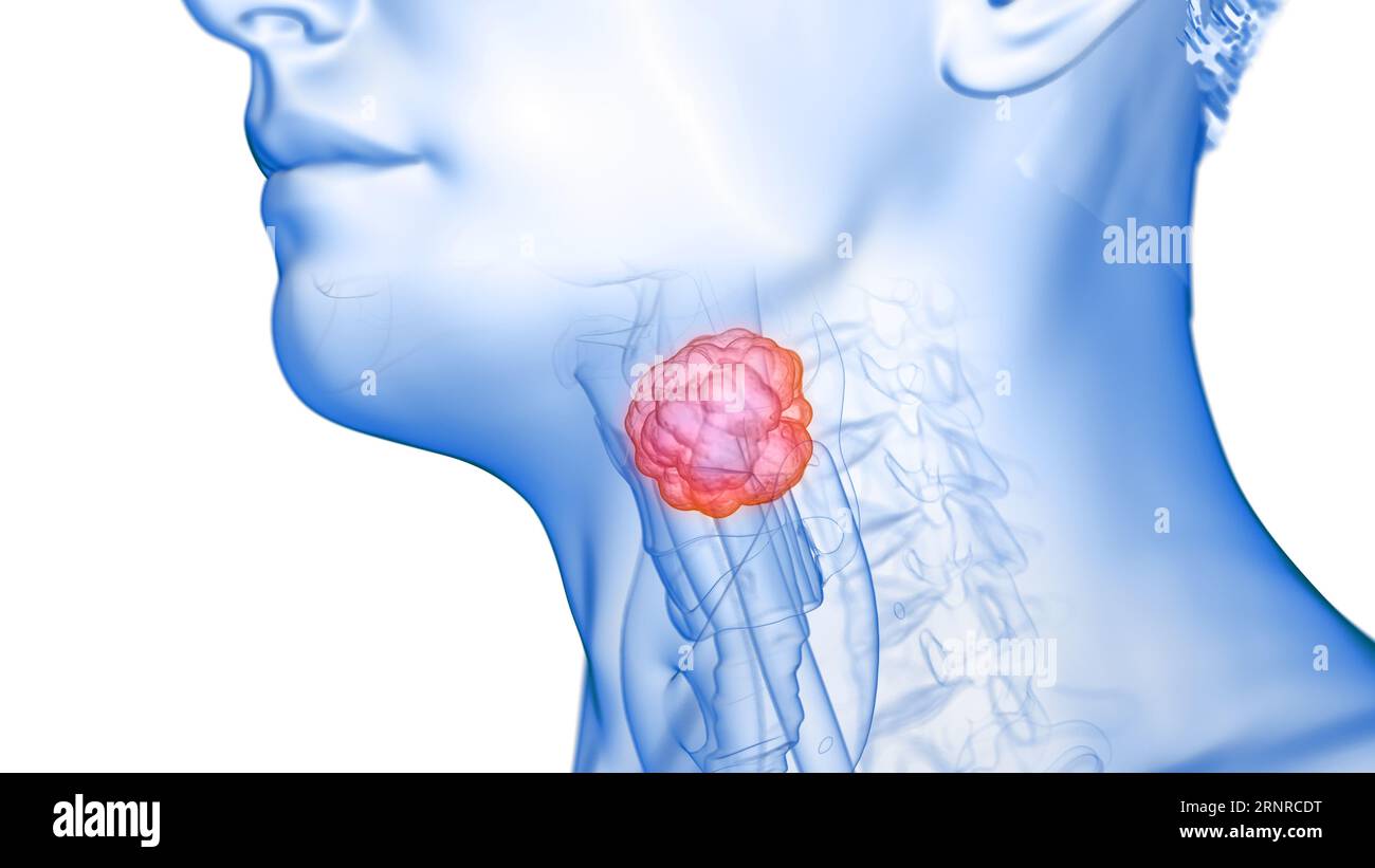 Larynx tumour, illustration Stock Photo - Alamy