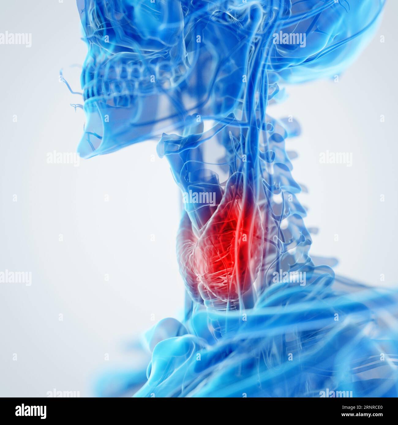 Inflamed thyroid gland, illustration Stock Photo - Alamy