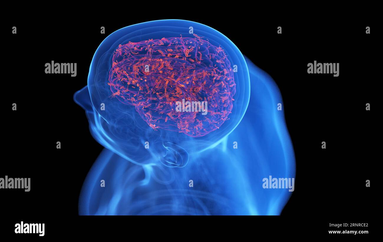 Infected human brain, illustration Stock Photo - Alamy