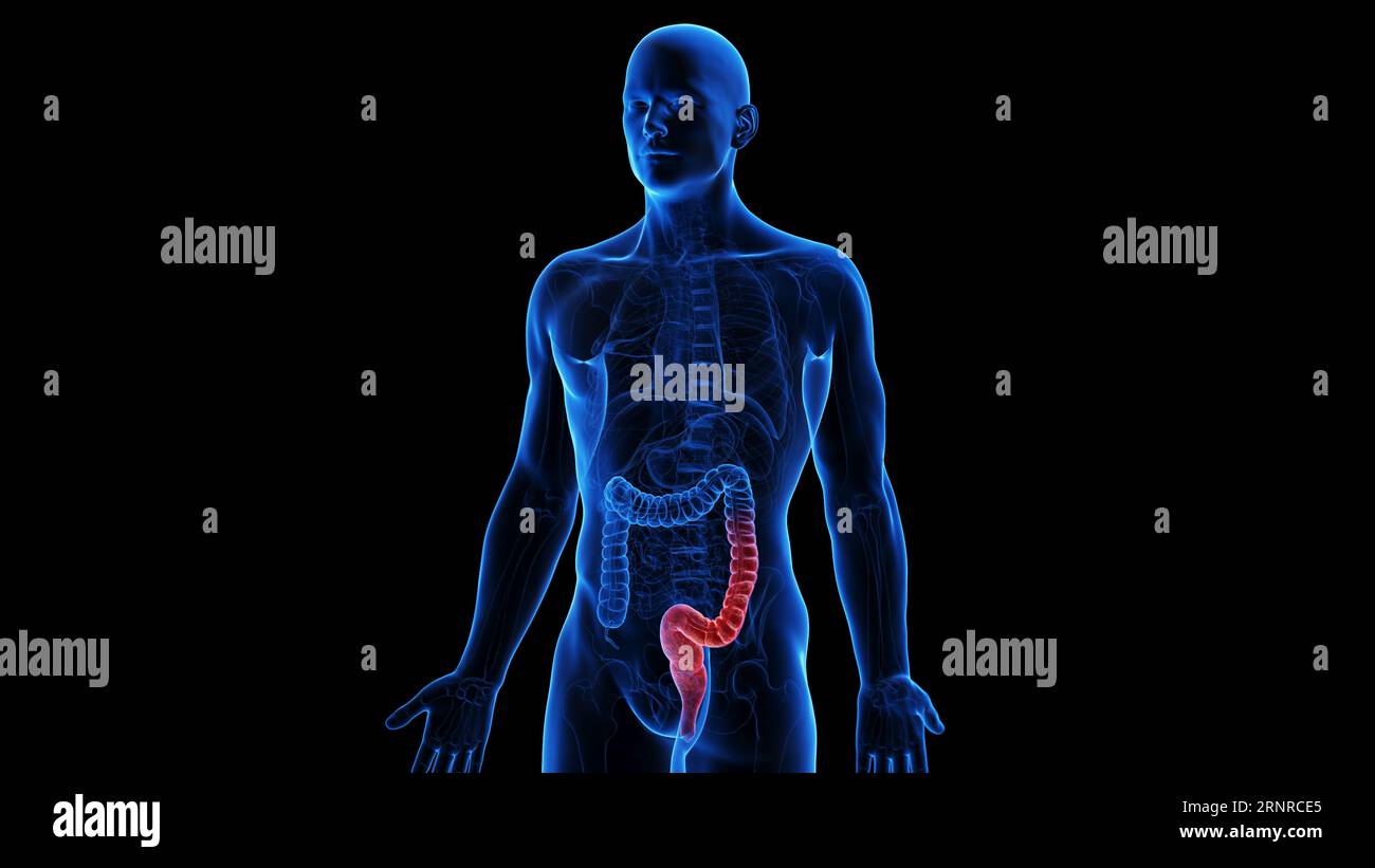 Ulcerative colitis, illustration Stock Photo - Alamy