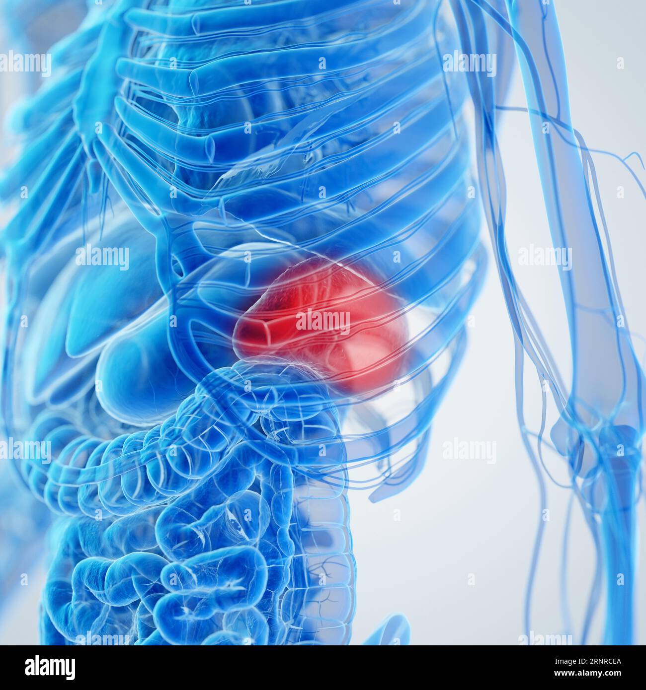 Diseased spleen hi-res stock photography and images - Alamy