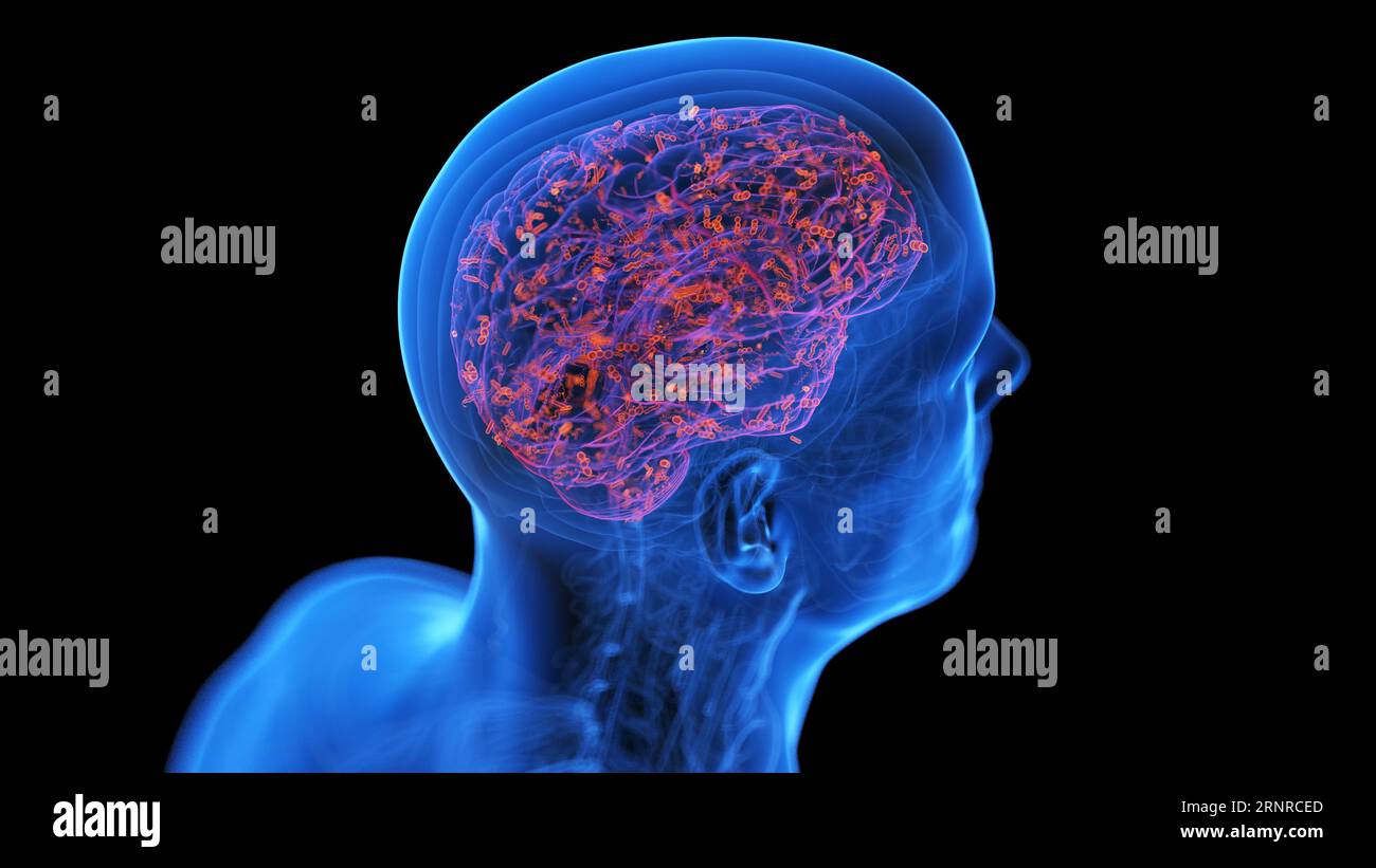 Infected human brain, illustration Stock Photo - Alamy