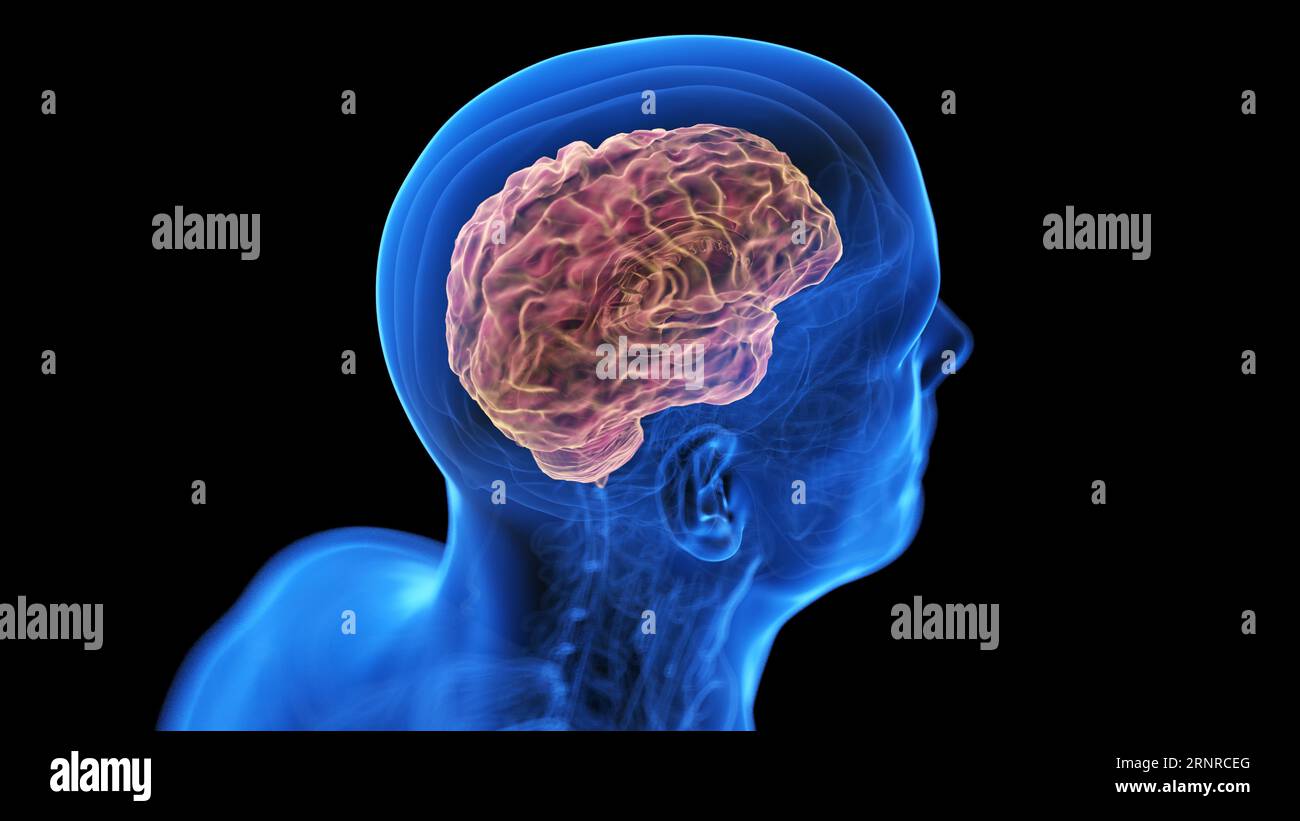 Degenerated human brain, illustration Stock Photo - Alamy
