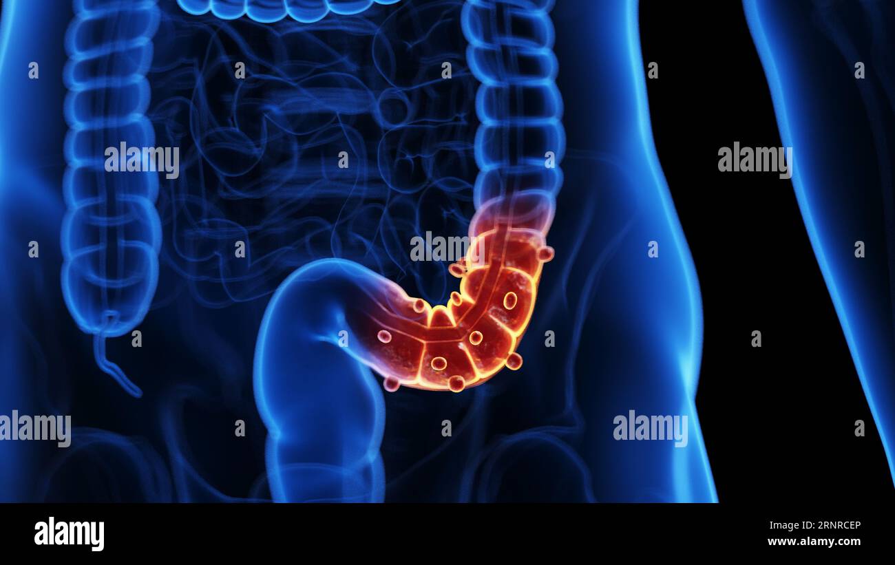 Diverticulitis intestinal hi-res stock photography and images - Alamy
