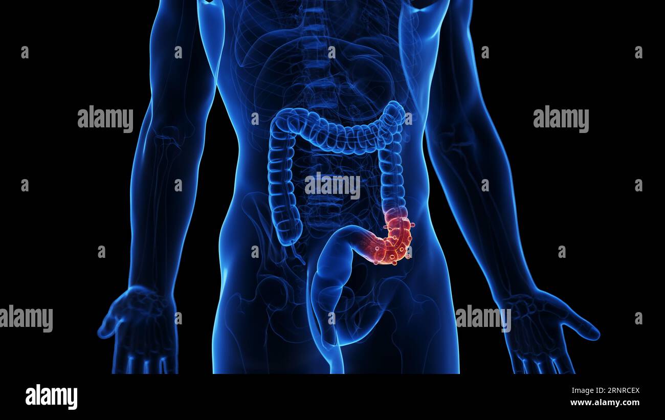 Ulcerative colitis, illustration Stock Photo - Alamy