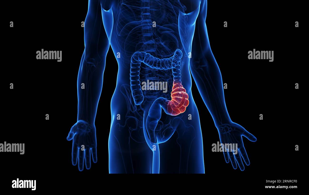 Blocked colon, illustration Stock Photo - Alamy