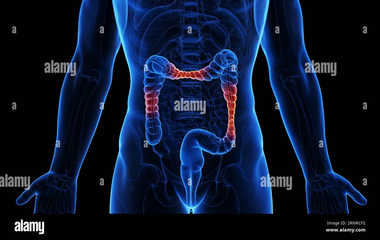 Inflammatory bowel disease, illustration Stock Photo - Alamy