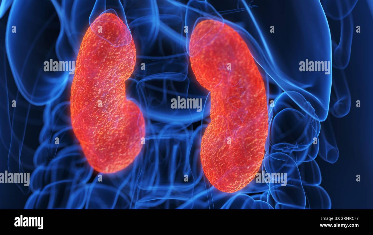 Inflamed kidneys, illustration Stock Photo - Alamy