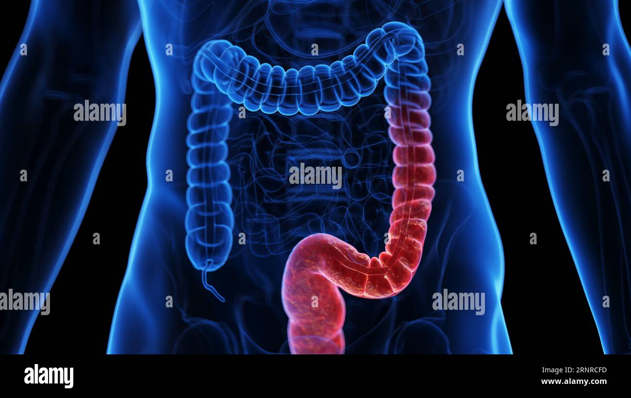 Ulcerative colitis, illustration Stock Photo - Alamy