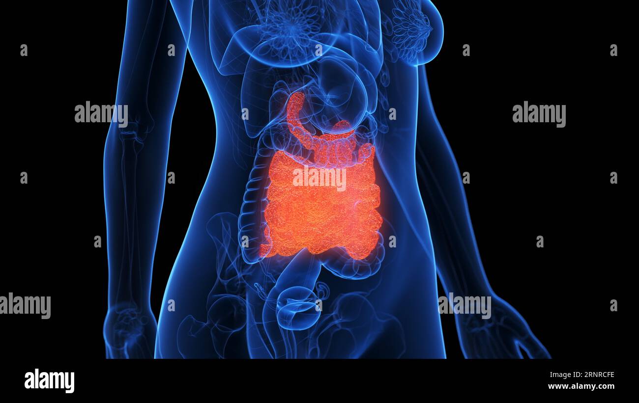 Inflamed small intestine, illustration Stock Photo - Alamy