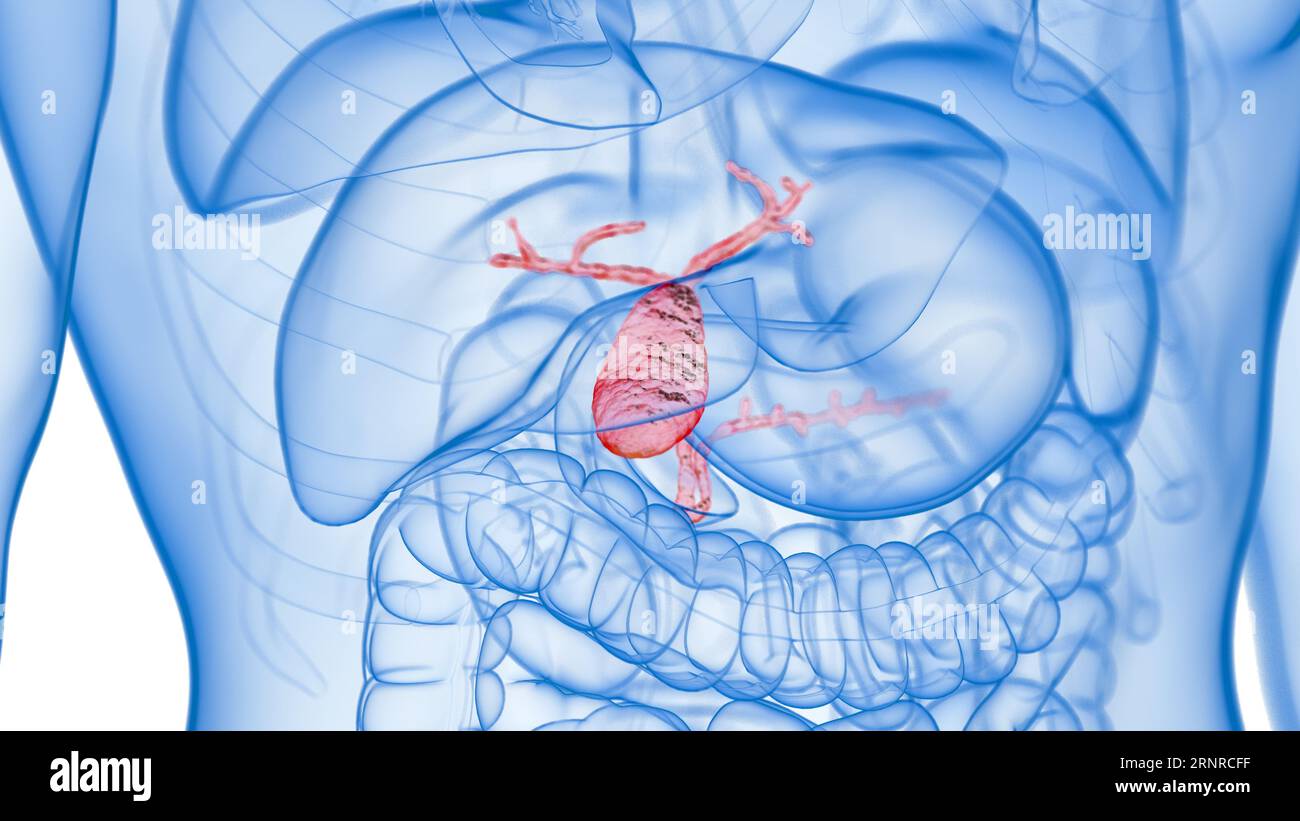 Inflamed gallbladder, illustration Stock Photo - Alamy