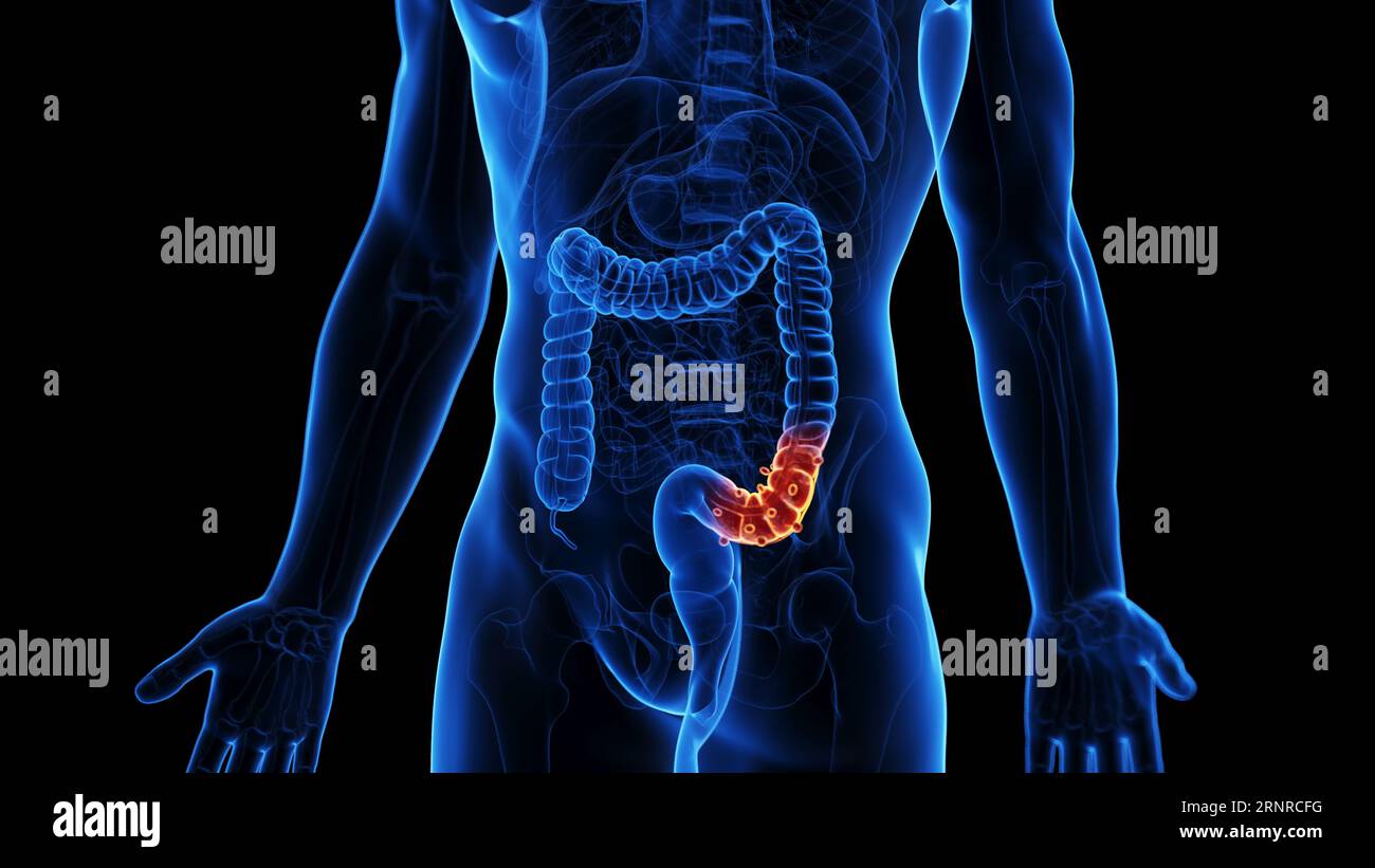 Diverticulitis intestinal hi-res stock photography and images - Alamy