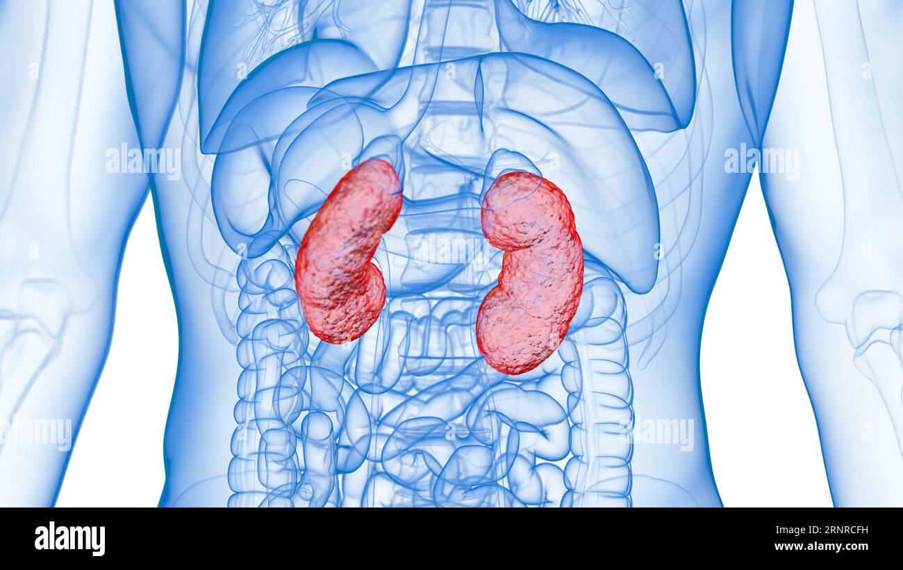 Inflamed kidneys, illustration Stock Photo - Alamy