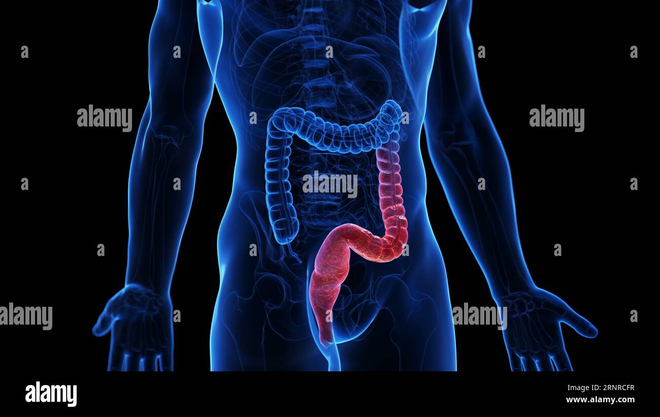Ulcerative colitis, illustration Stock Photo - Alamy