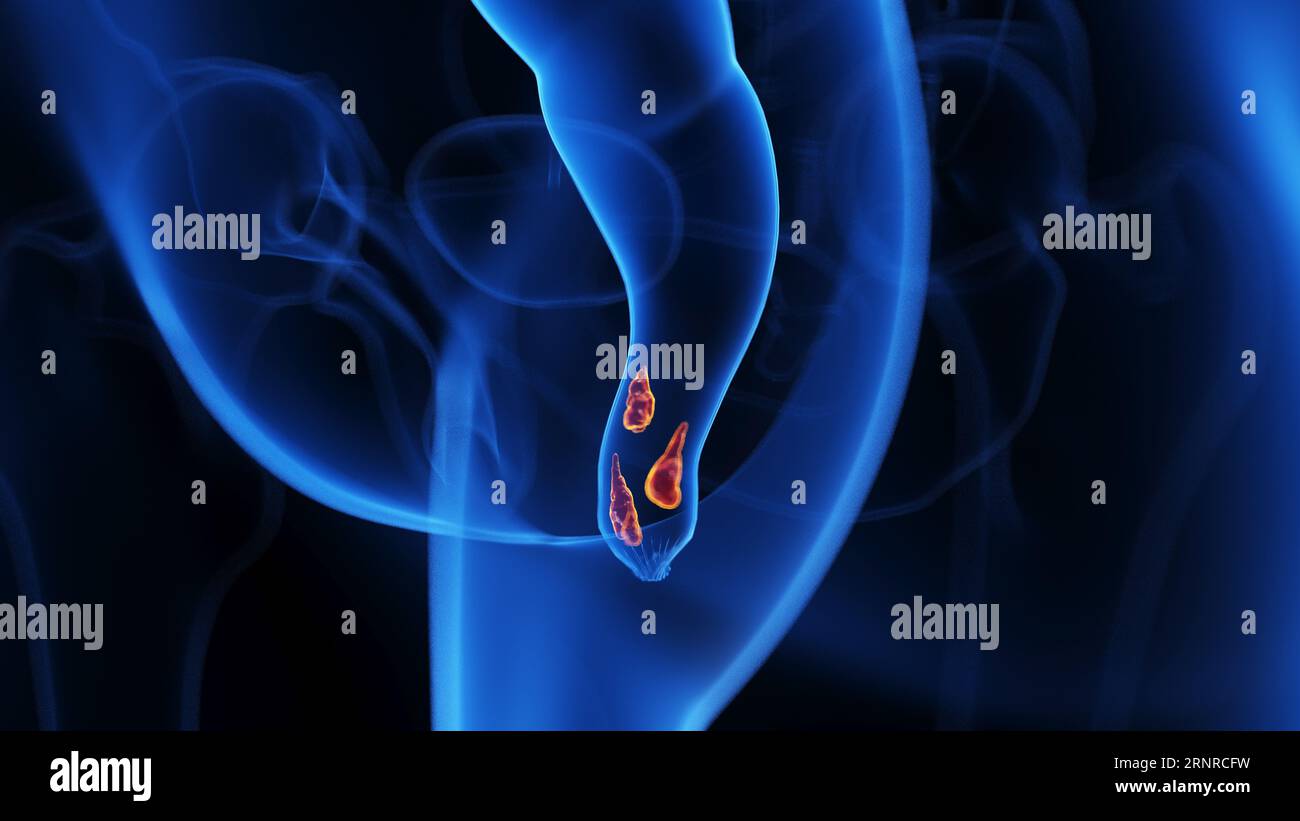 Hemorrhoids illustration hi-res stock photography and images - Alamy