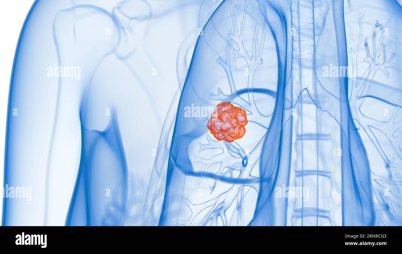 Lung cancer, illustration Stock Photo - Alamy