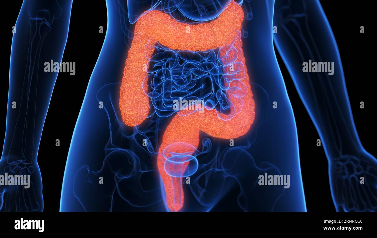 Inflamed colon, illustration Stock Photo - Alamy